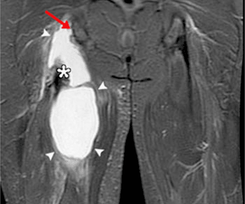 Hamstring Repair Surgery | Sydney Orthopaedic and Sports Injury Service