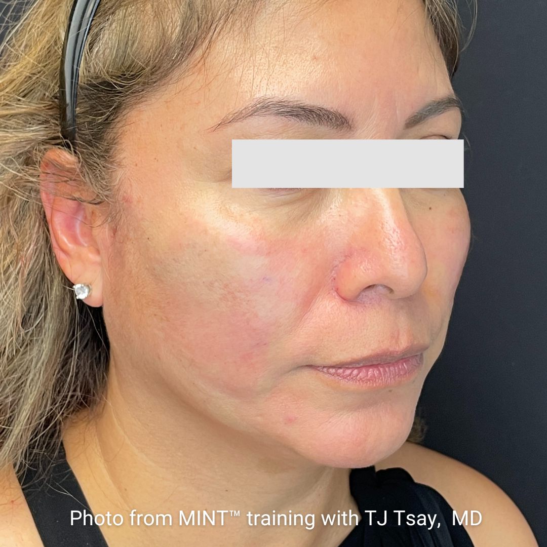 Discover MINT™, the first and only PDO threads with triple FDA clearances