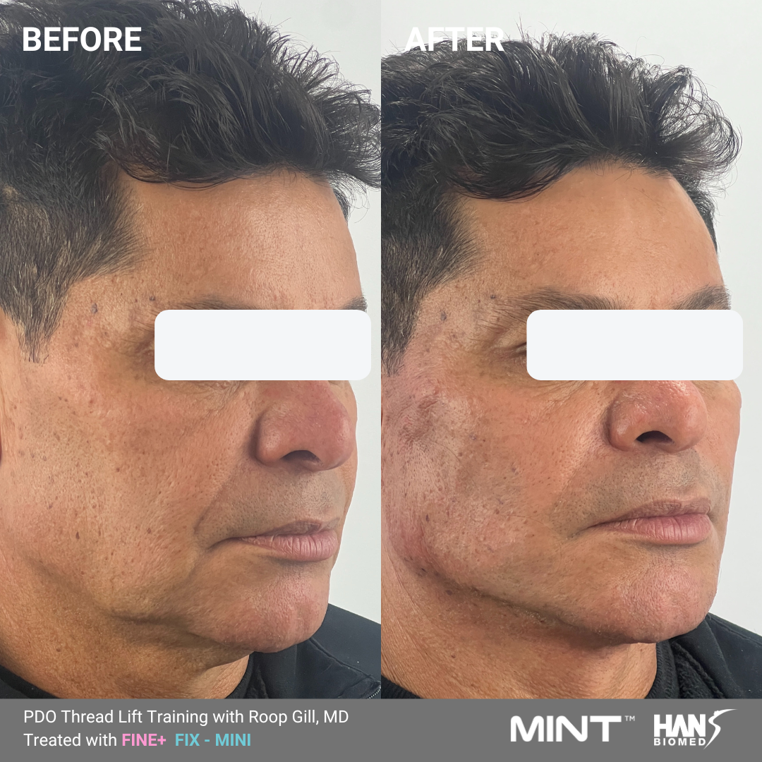 Non Surgical Facelifts for Men