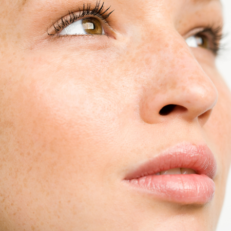 Restoring Cheek Volume with PDO Threads