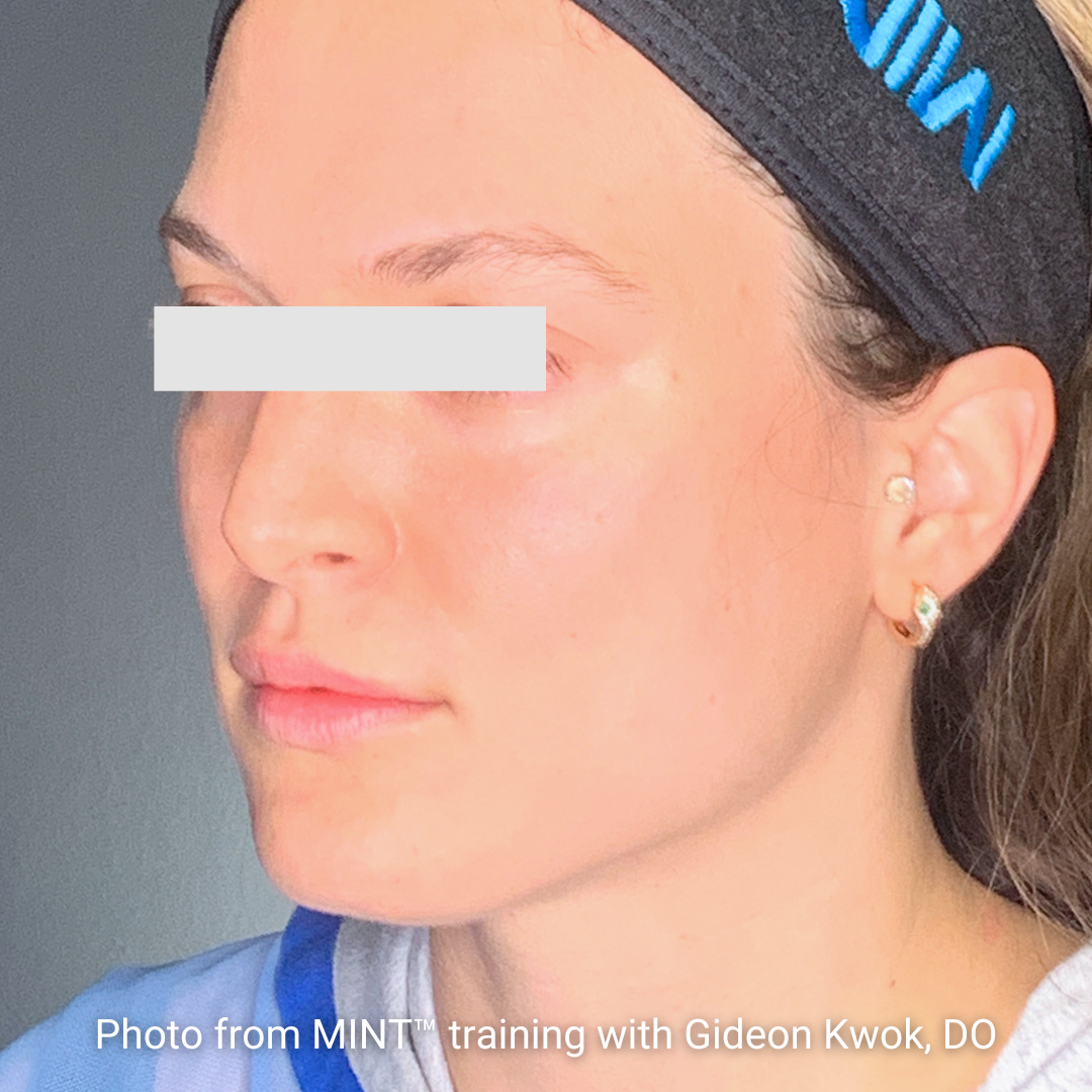 MINT™ Lift | Triple FDA Cleared PDO Threads