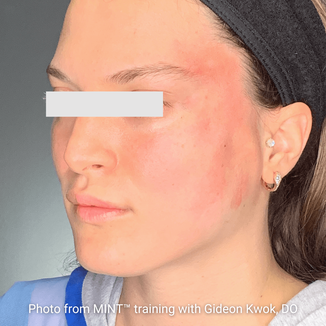 MINT™ Lift | Triple FDA Cleared PDO Threads