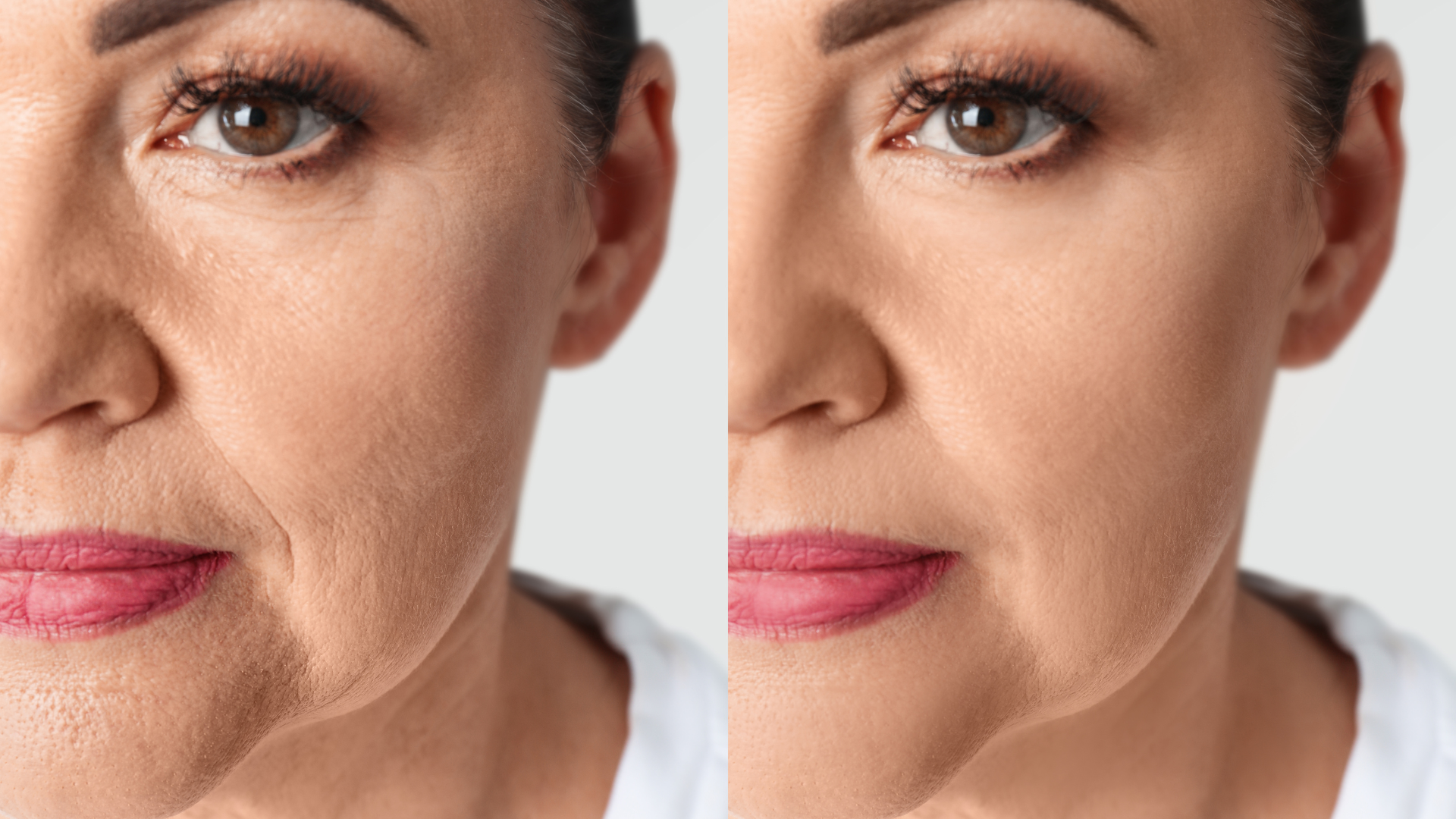 PDO Threads: The Key to Improving Your Smile Lines