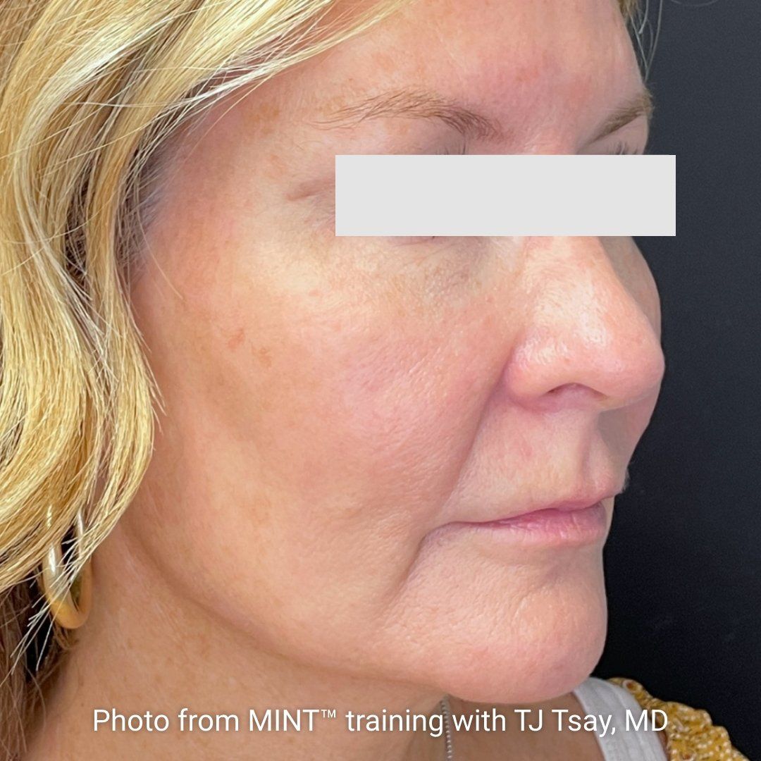 MINT™ Lift | Triple FDA Cleared PDO Threads