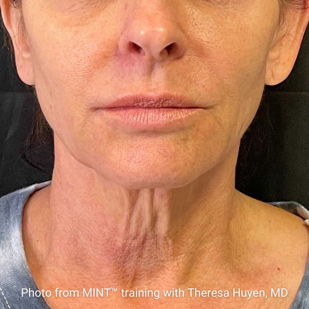 MINT™ Lift | Triple FDA Cleared PDO Threads