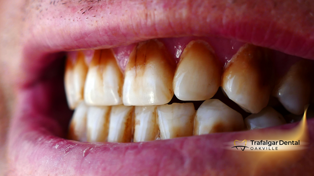 Why Do People Get Brown Spots On Their Teeth - Infoupdate.org