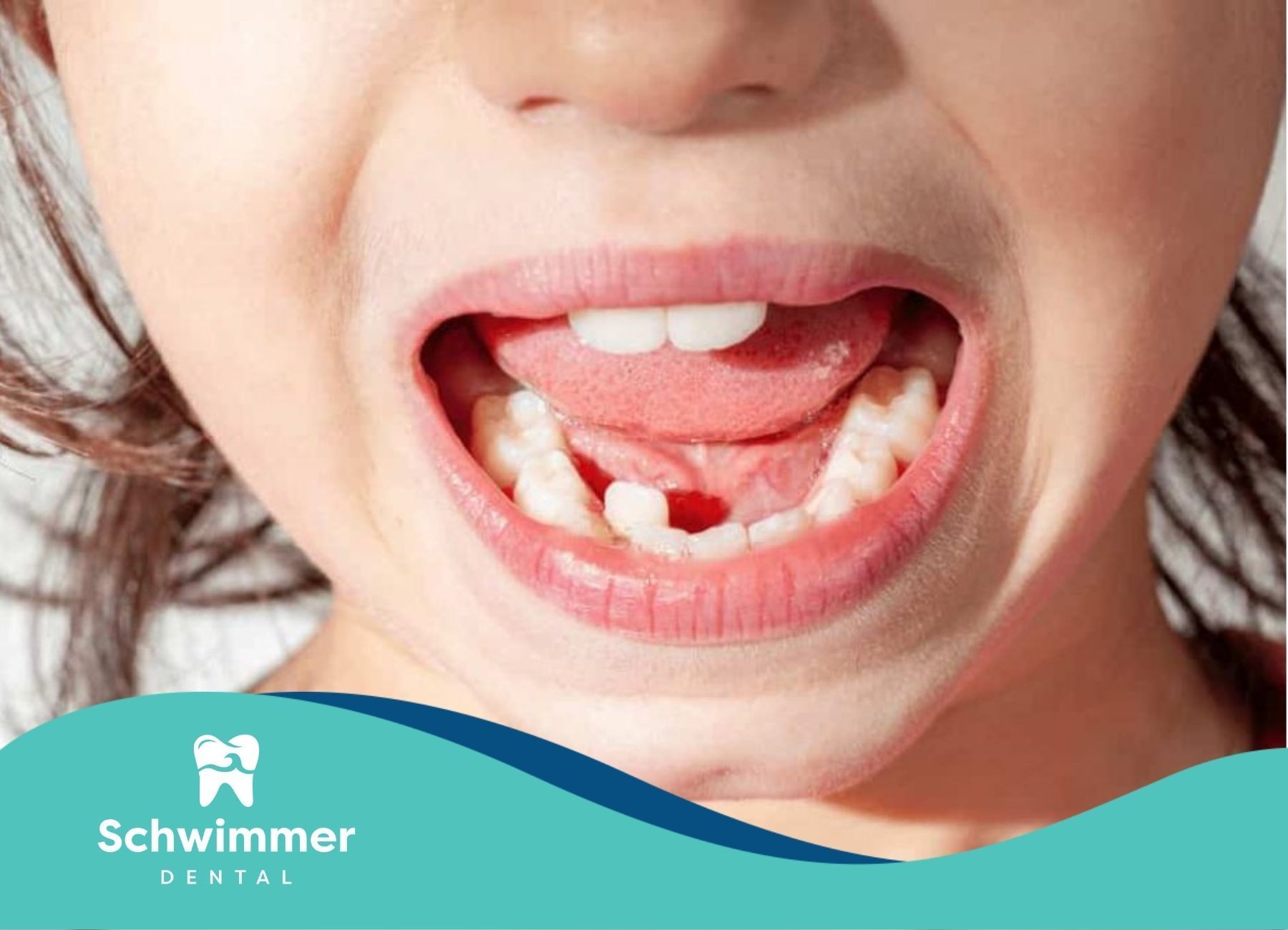 Crossbite vs Overbite: Key Differences Explained | Schwimmer