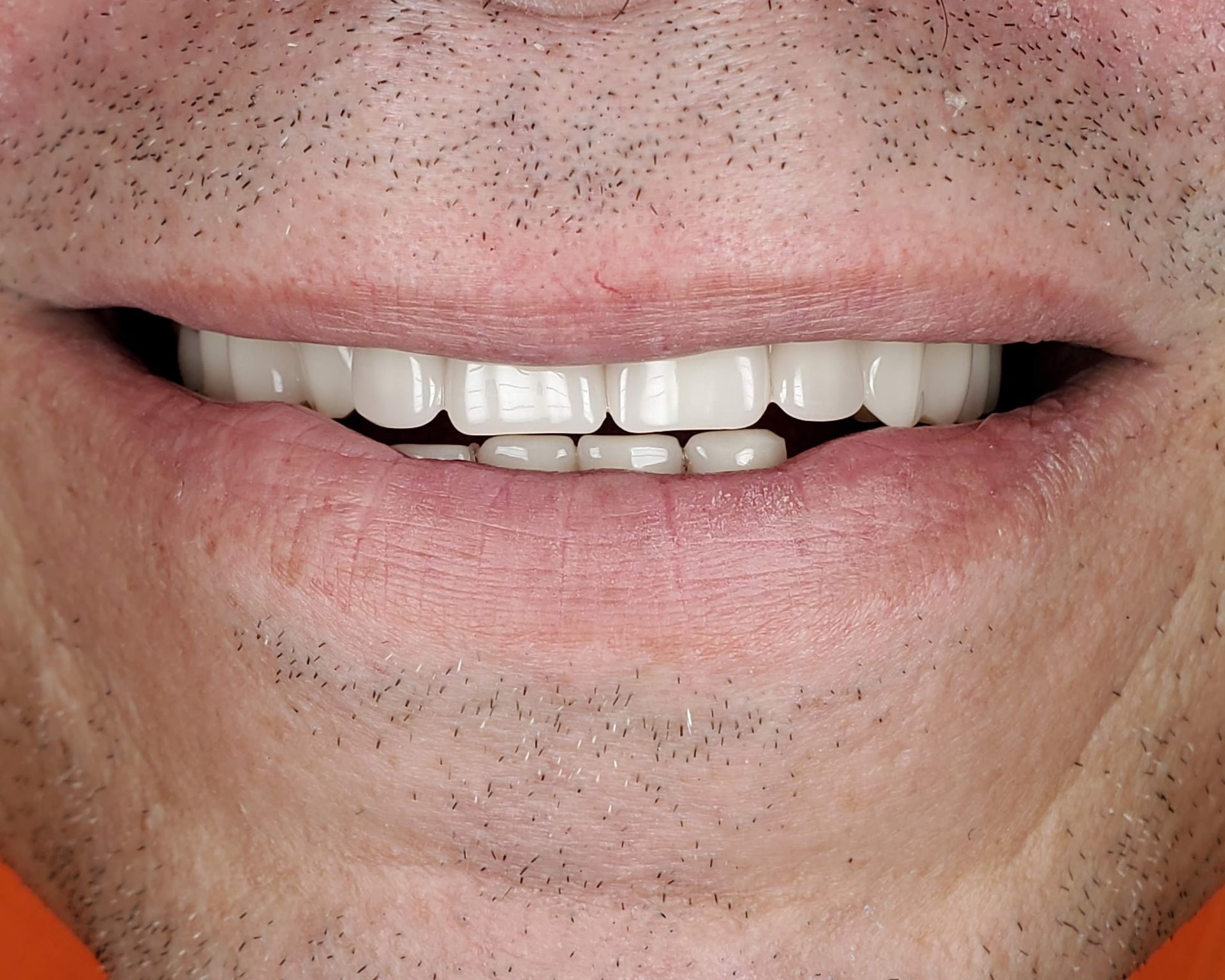 Schwimmer Dental | Smile Gallery | Crowns | Clear Aligners | Dentures