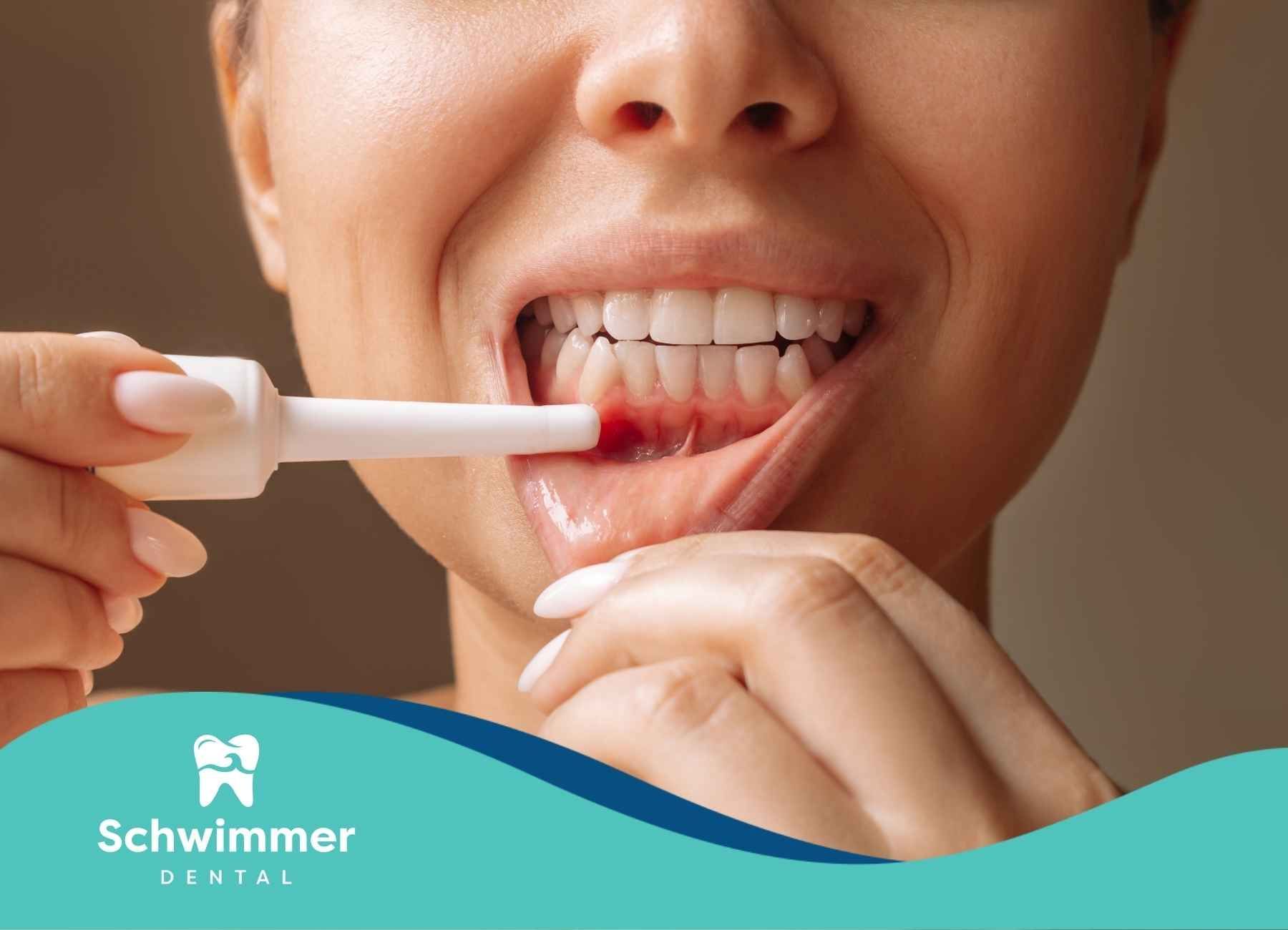 How to Treat Cavities at the Gum Line? | Schwimmer Dental