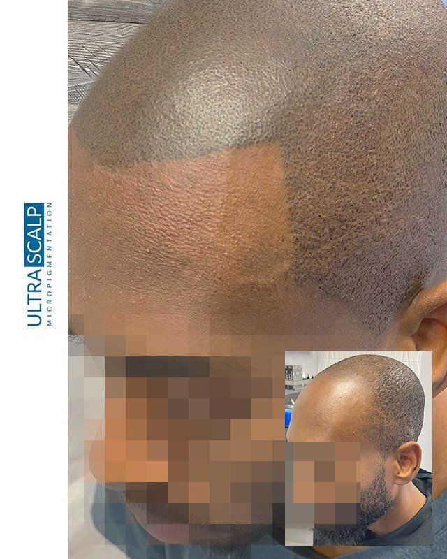 Is Scalp Micropigmentation Safe To Get?