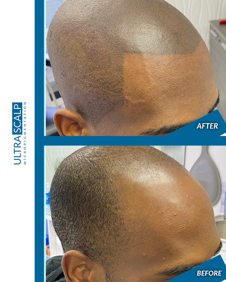 Scalp Micropigmentation Tampa Bay | Hair Tattoo Lutz Spring Hill Tampa