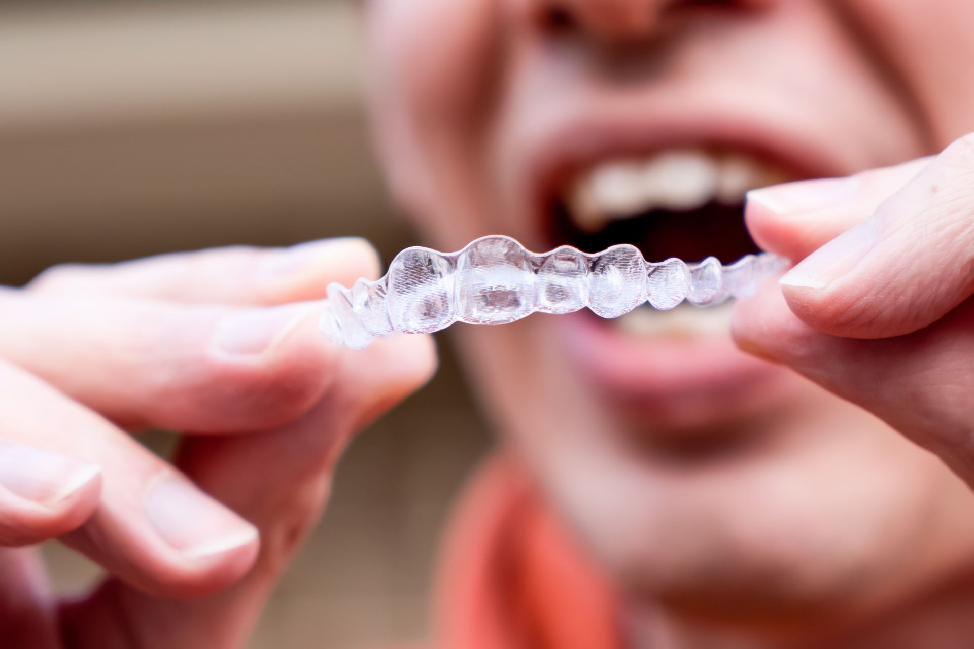 Can Invisalign® Chip Your Teeth? | Modern Day Smiles