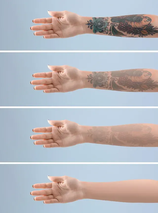 Say Goodbye to Tattoo Regrets: Guide to Removing Tattoos