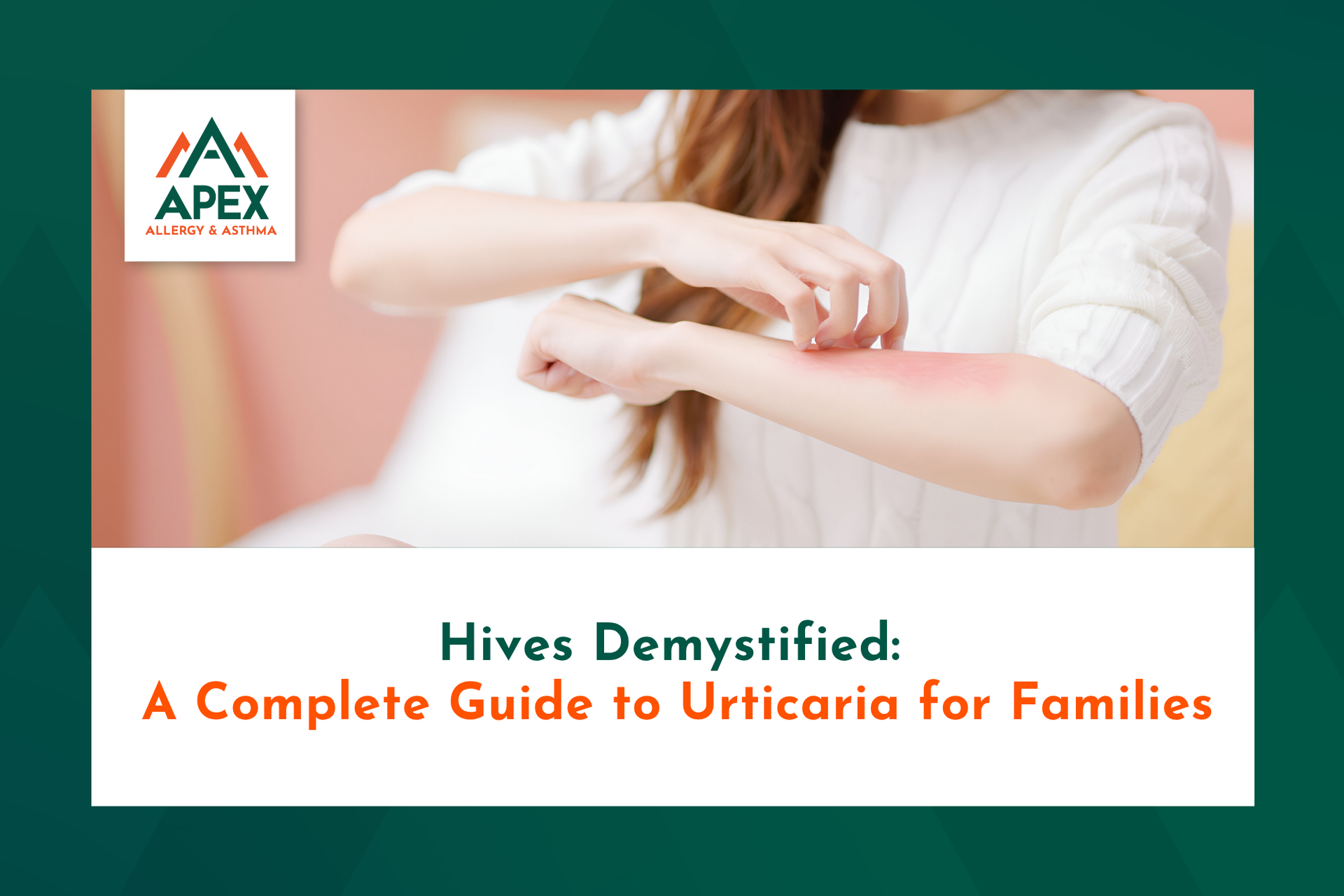 Everything You Need to Know About Hives or Urticaria