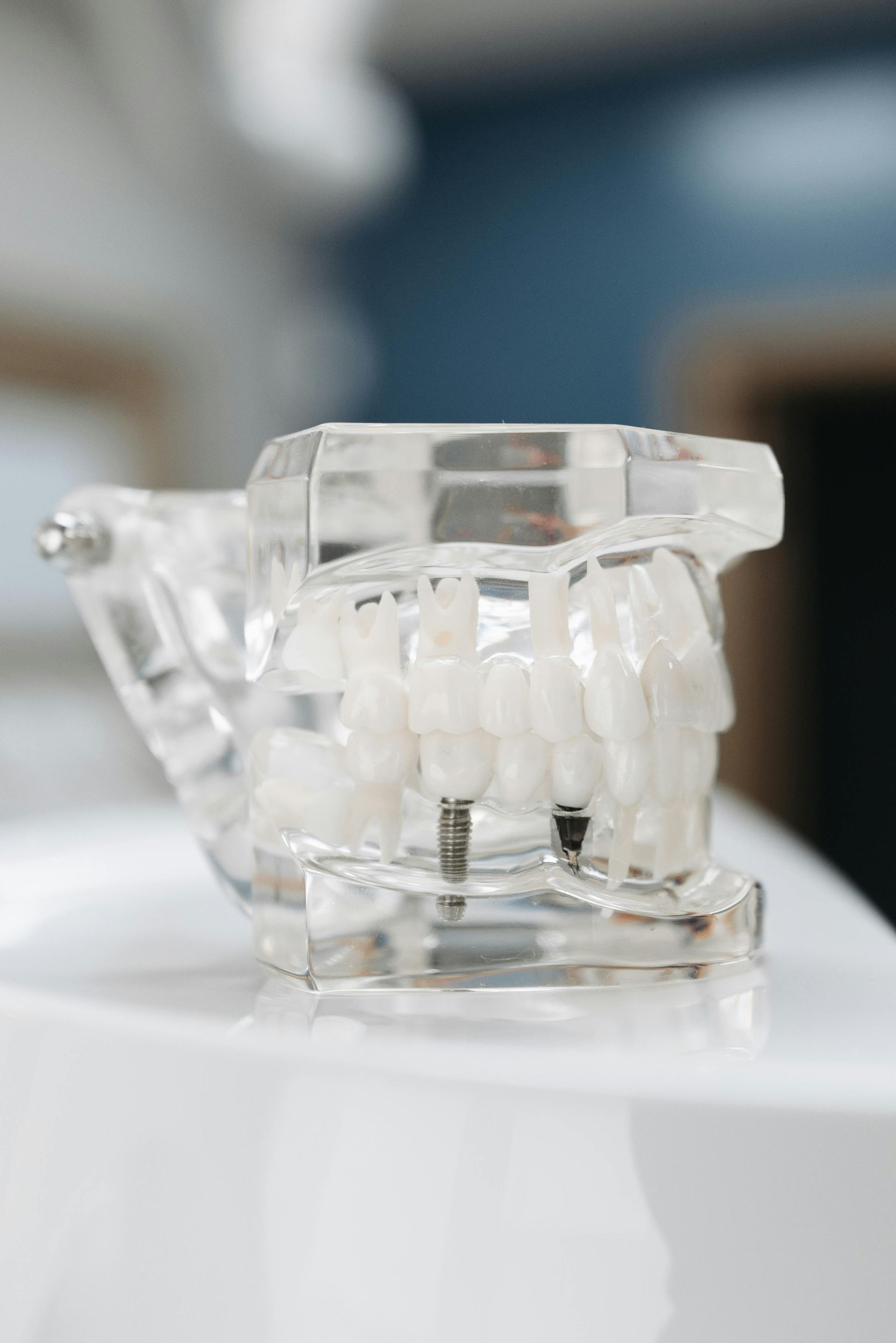 Dental Implants vs. Your Daily Routine: How Lifestyle Choices Affect ...
