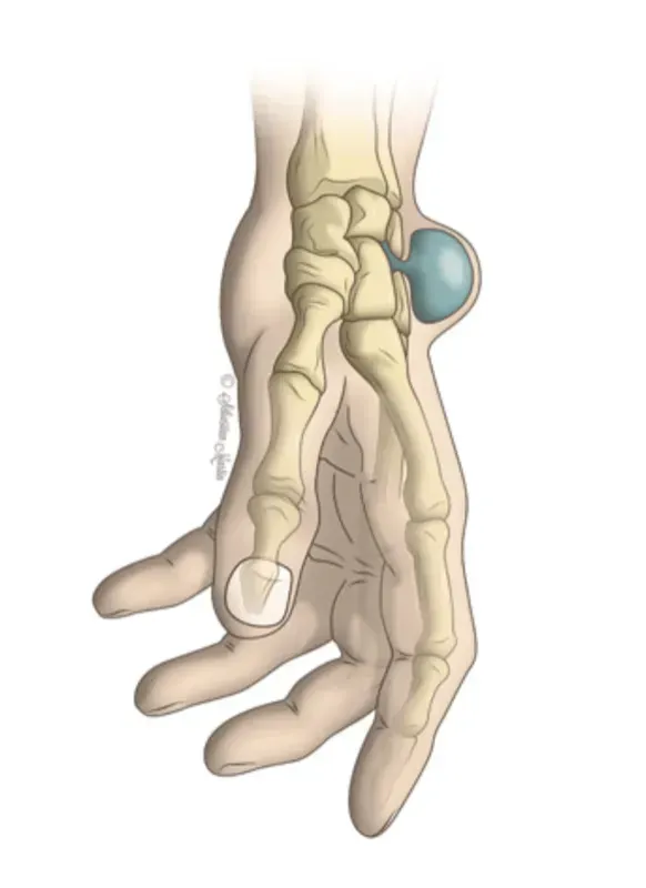 Kyste Synovial Le Kyste Synovial Orthopédie Brest