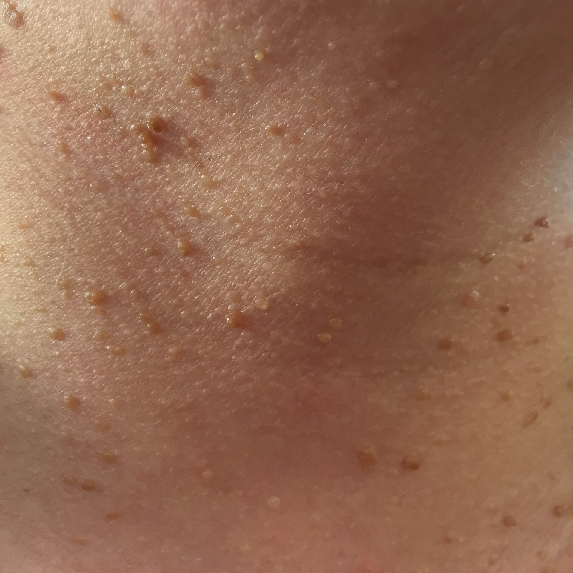 Skin Lesion Removal Treatment in Perth, WA