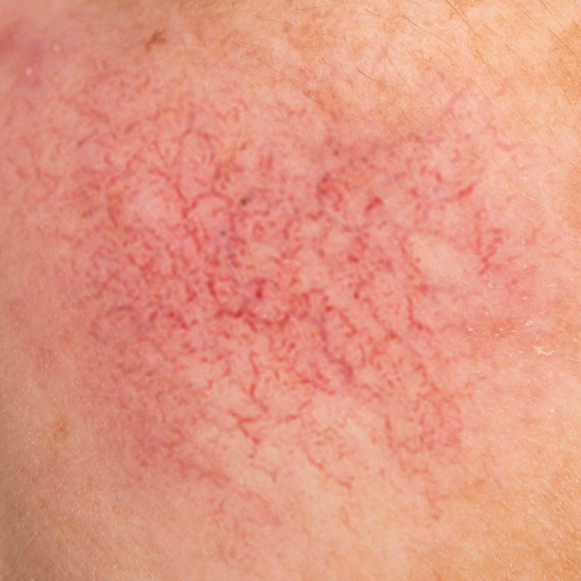 Skin Lesion Removal Treatment in Perth, WA