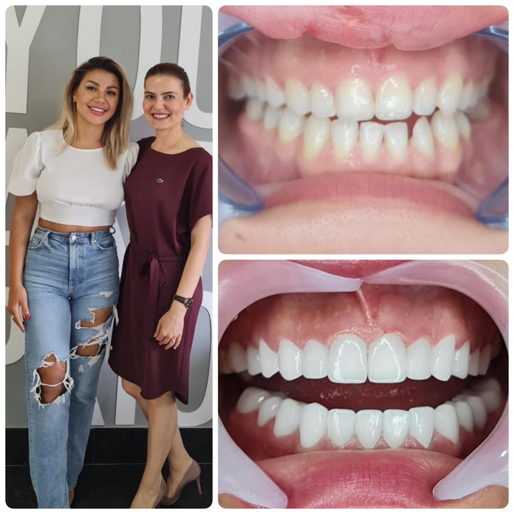 UK Smiles - #1 In Turkey Teeth Dental Treatments