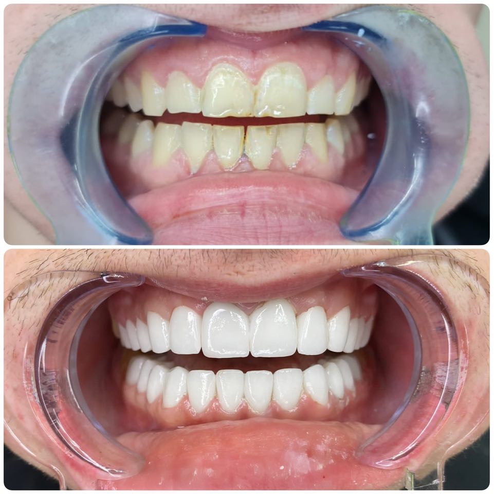 UK Smiles - #1 In Turkey Teeth Dental Treatments