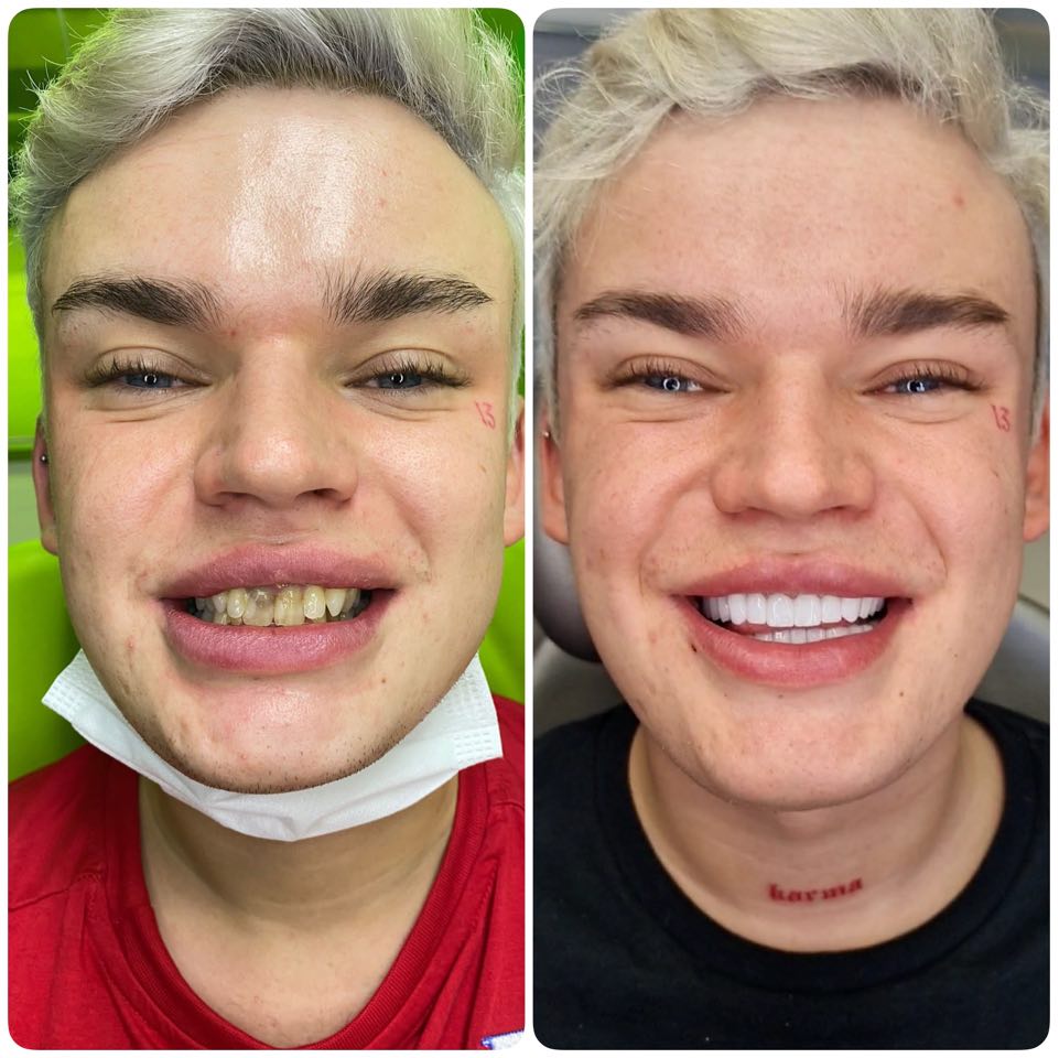 UK Smiles - #1 In Turkey Teeth Dental Treatments