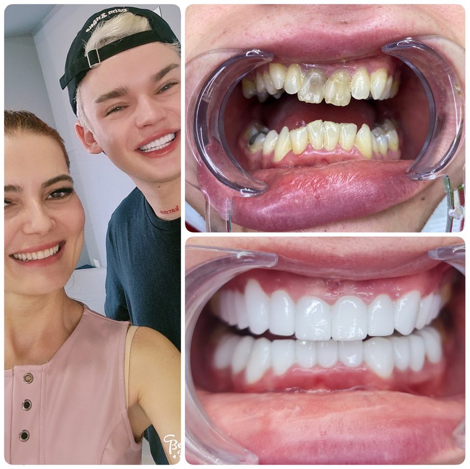 UK Smiles - #1 In Turkey Teeth Dental Treatments