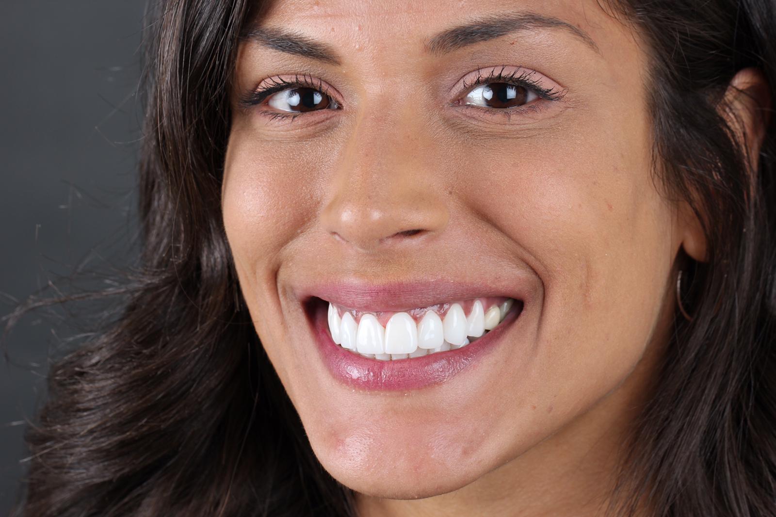 UK Smiles - #1 In Turkey Teeth Dental Treatments