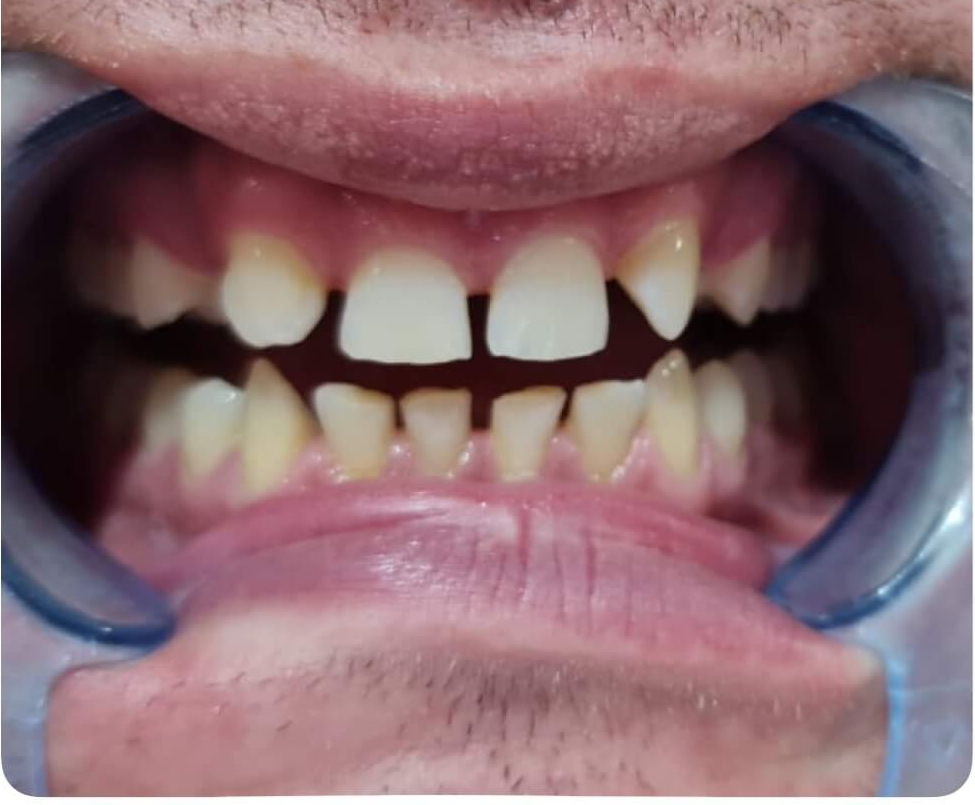 How Much Do Veneers Cost In Turkey? (2022) Complete Breakdown