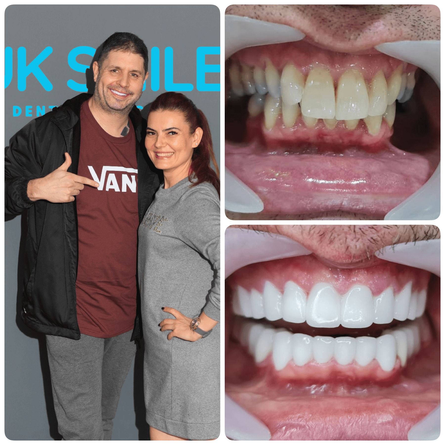 UK Smiles - #1 In Turkey Teeth Dental Treatments
