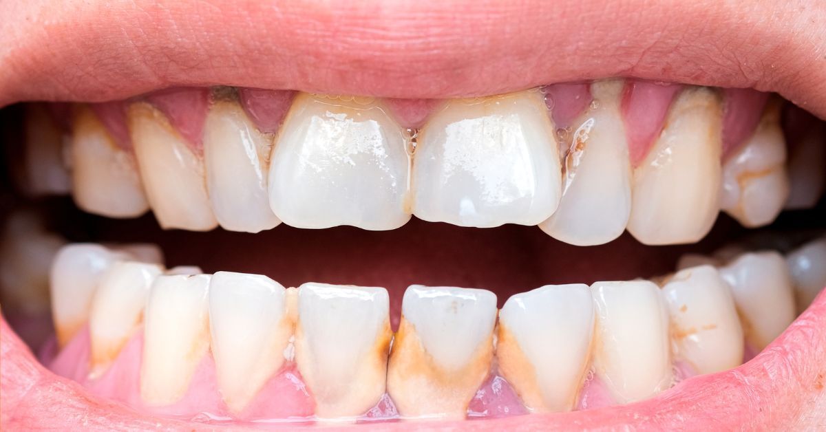 10 Early Signs of Tooth Decay