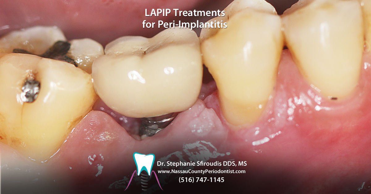 LAPIP Treatments for Peri-Implantitis - Dr. Stephanie Sfiroudis
