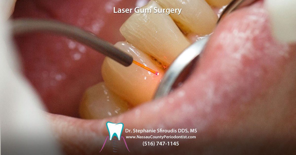 Laser Gum Surgery - Dr. Stephanie Sfiroudis DDS, MS