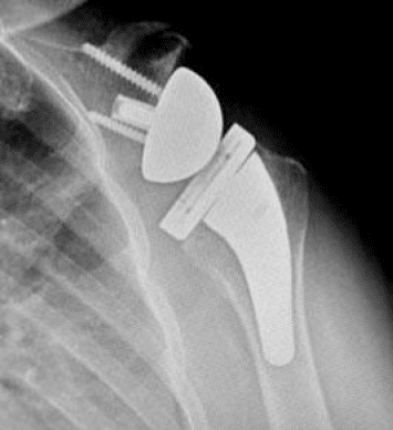 Shoulder Replacement | Align Orthopaedics | South Brisbane