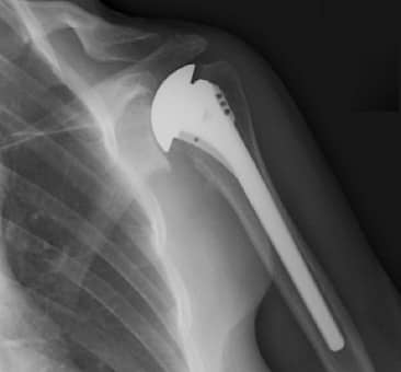 Shoulder Replacement | Align Orthopaedics | South Brisbane