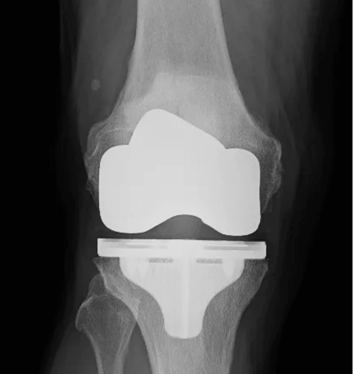 Total Knee Replacement Total Knee Replacement New Iberia, LA