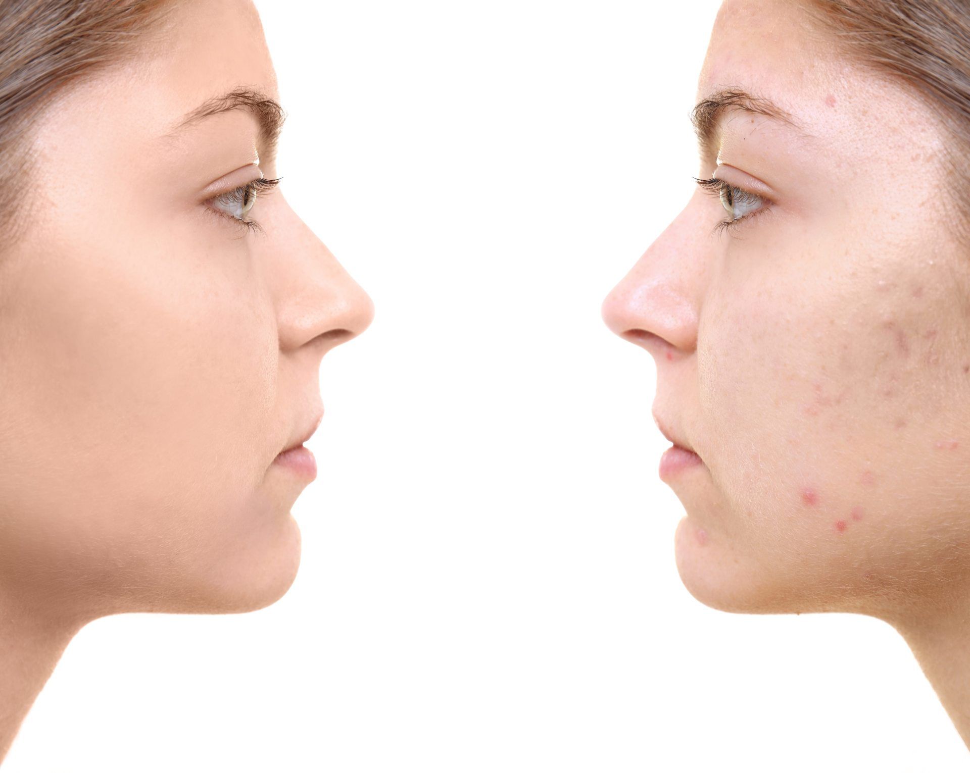 Tudo que você precisa saber sobre acne