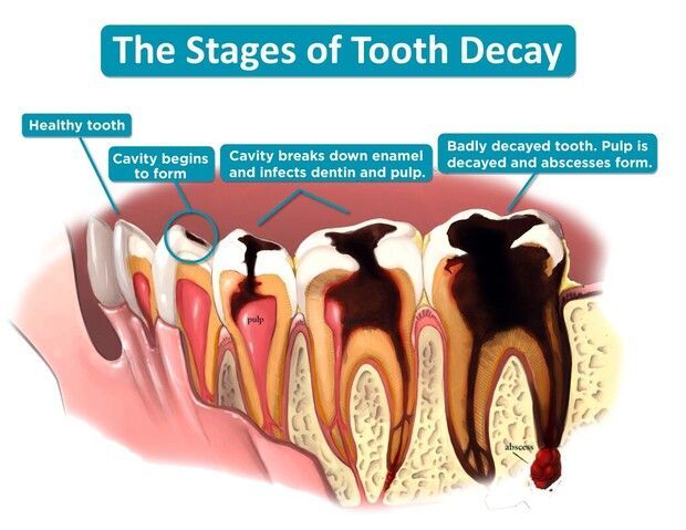 What Causes Cavities (Tooth Decay)???