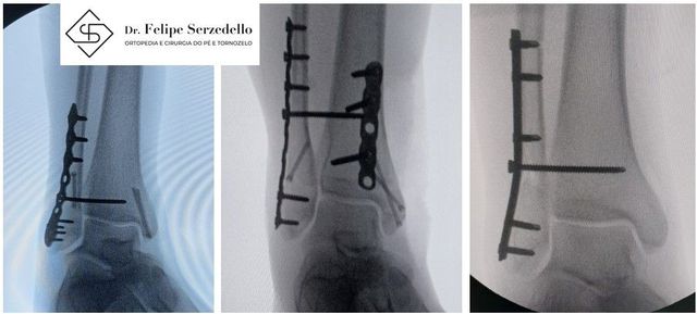 Tratamento De Fratura De Tibia A Importância Da Fisioterapia No