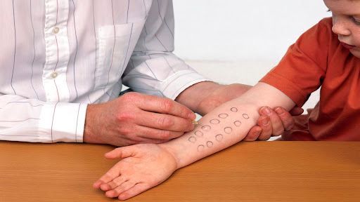 A Skin Prick Test In Children And How Its Works