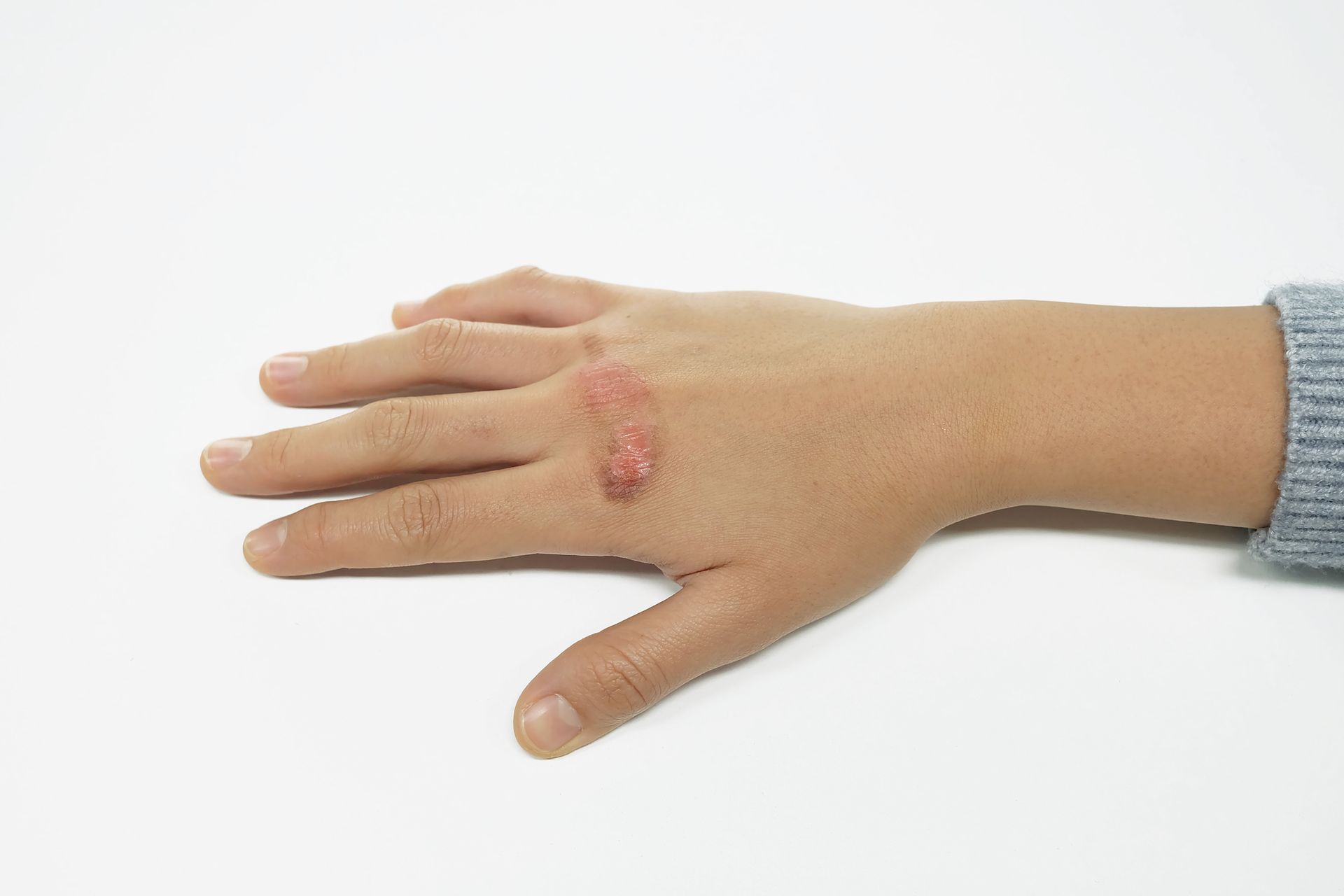 Modern Wound Care Tips & Techniques | OnSite Advanced Care