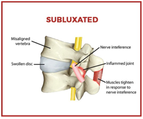 What is a Subluxation?