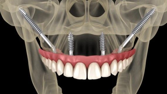 Implante zigomático: saiba o que é e como é feito