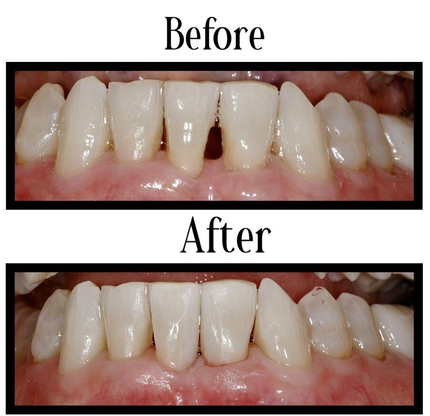 Teeth Cleaning | Dental Wellness of Bartow | Bartow, FL