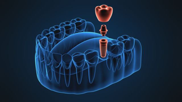 Dental Implant Wallpaper