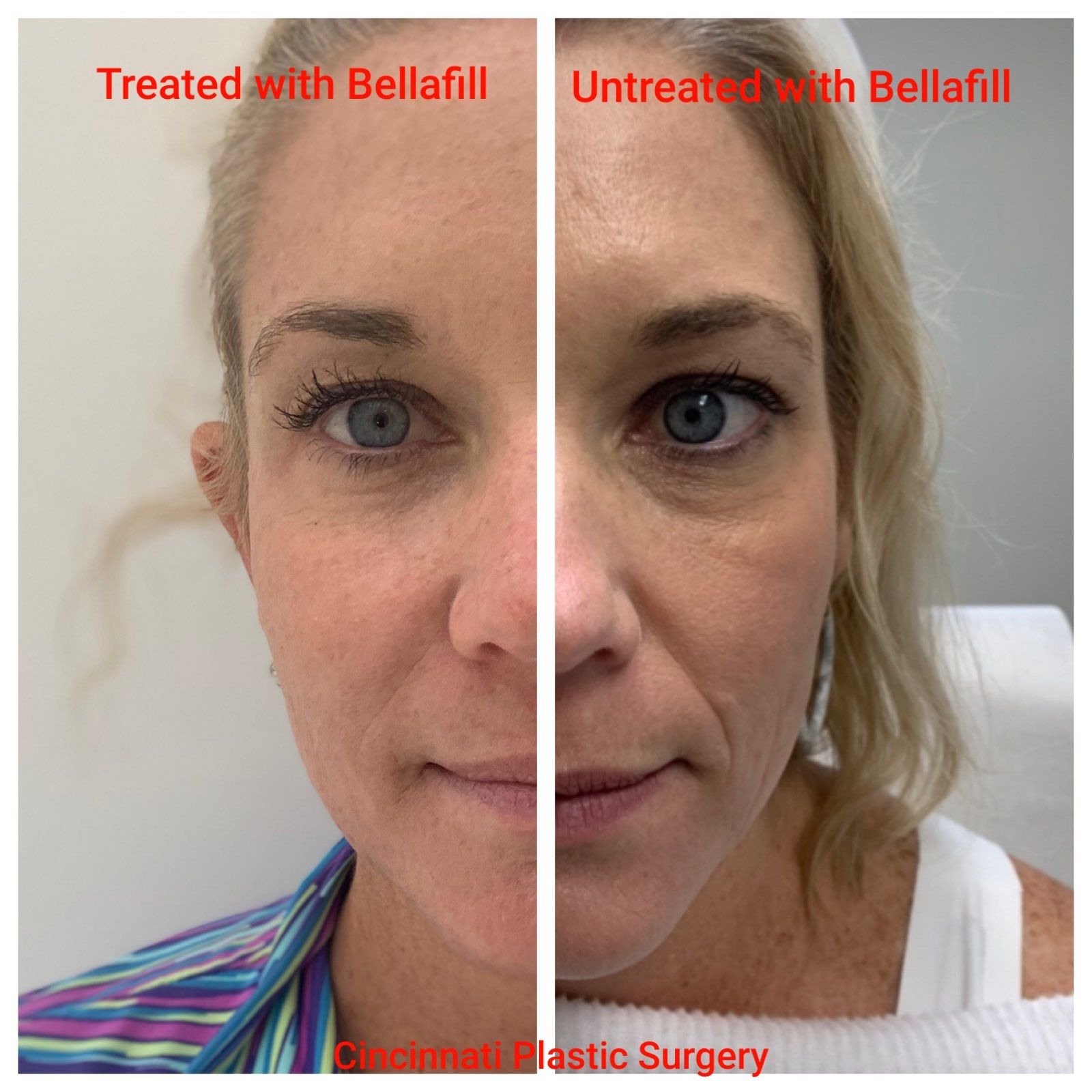 Bellafill - Pure Beauty Med Spa