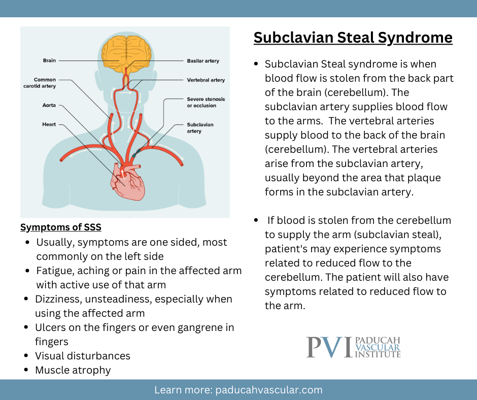 Subclavian Steal Syndrome