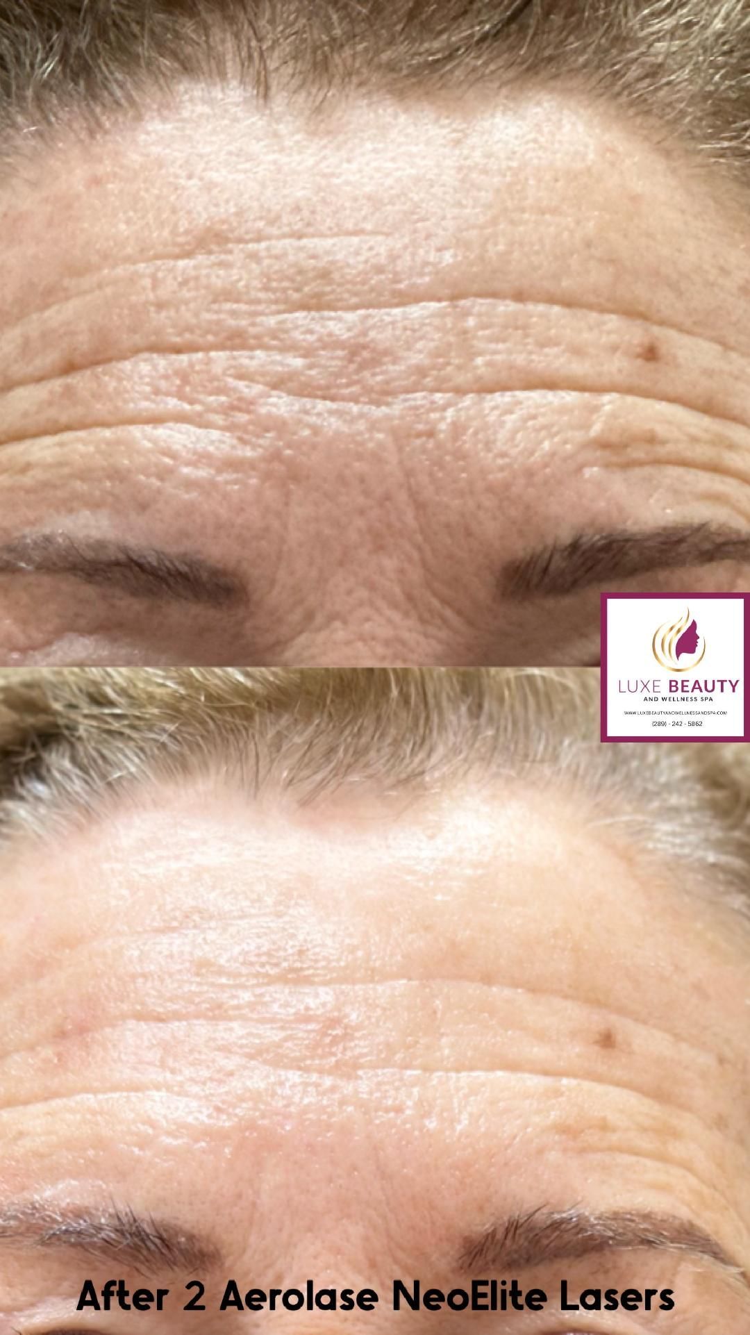 Aerolase Neo Elite Mississauga ON - Luxe Beauty and Wellness Spa