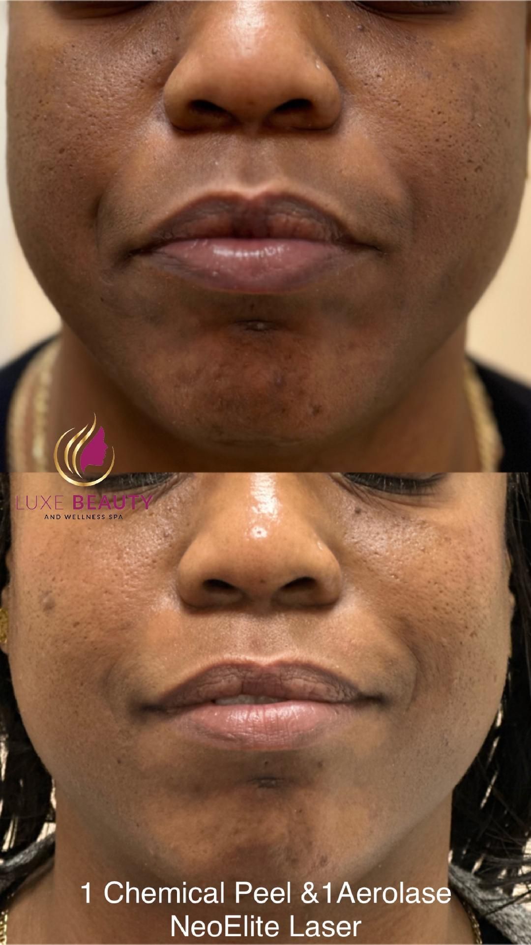 Aerolase Neo Elite Mississauga ON - Luxe Beauty and Wellness Spa