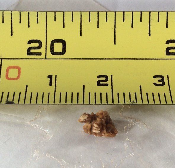 Kidney Stone Images