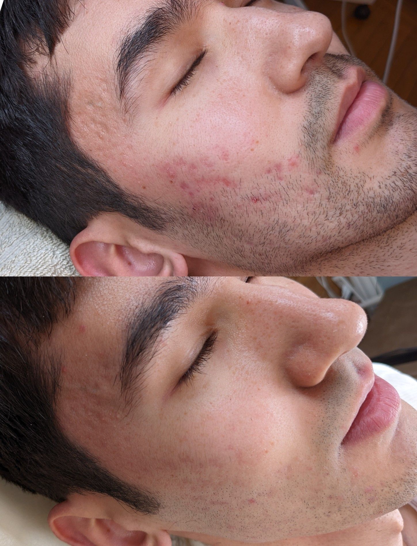 Microneedling for Acne Scars and Skin Rejuvenation: What You Need to Know